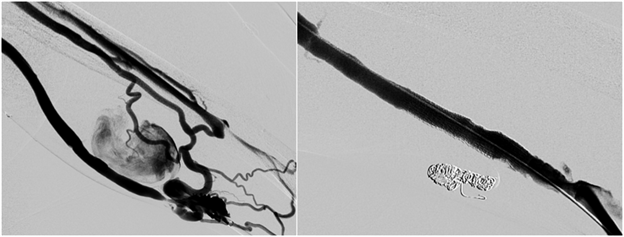 Dialysis Access Interventions | Department of Radiology